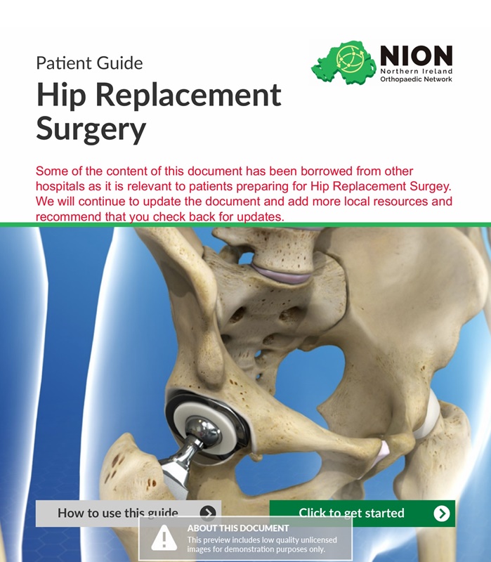 Hip Replacement Surgery Guide